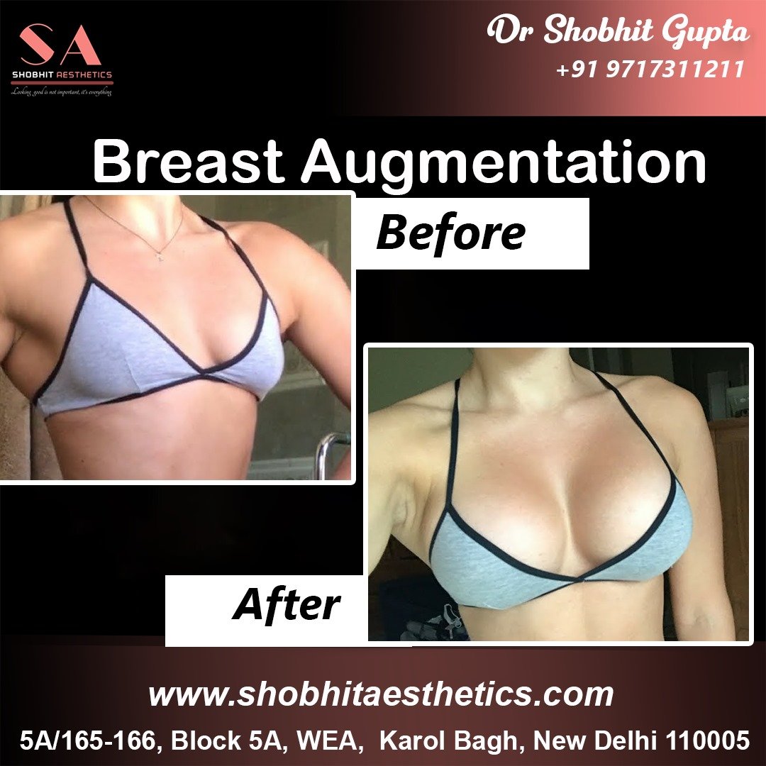 Breast Augmentation Transaxillary Breast Augmentation Pros Cons